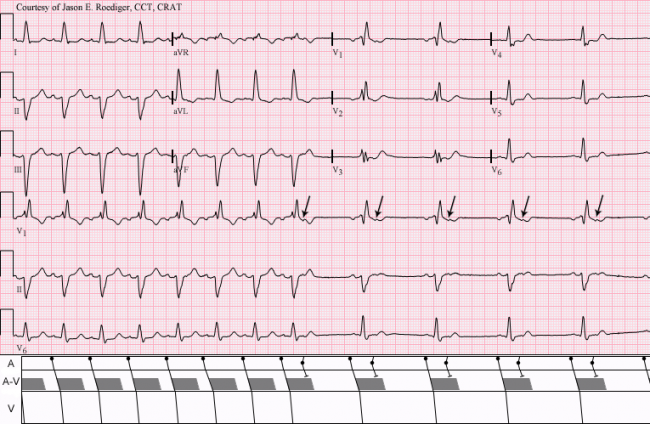 Non-conducted PACs | ECG Guru - Instructor Resources